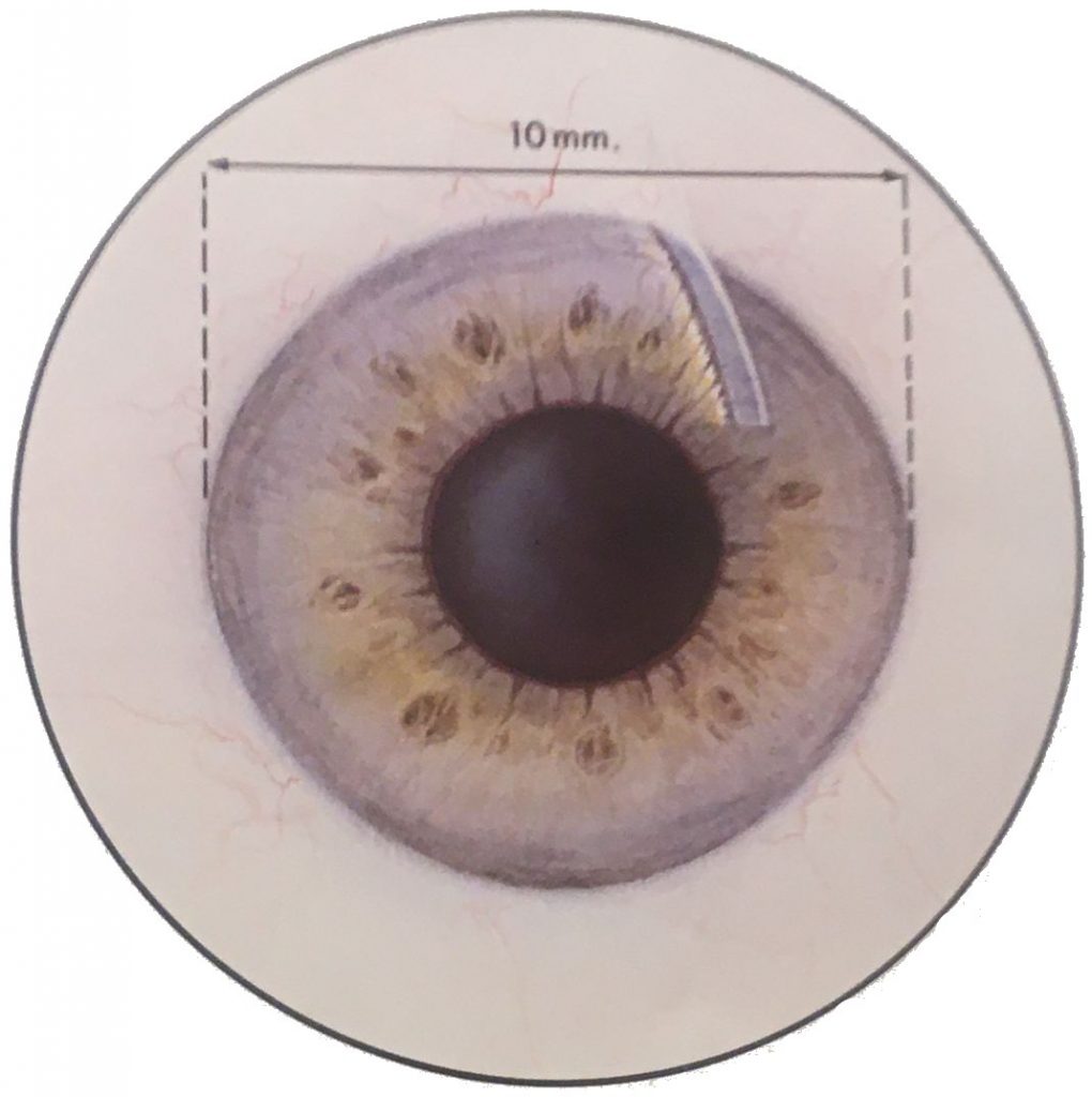 Nanophthalmos - Mr Eyes
