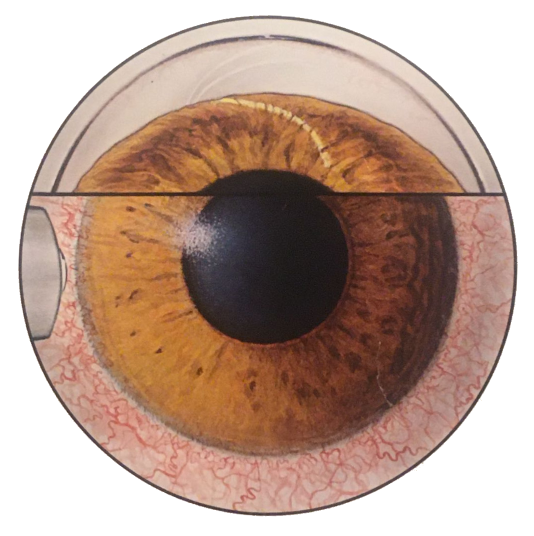 Acute Angle-Closure Glaucoma - Mr Eyes