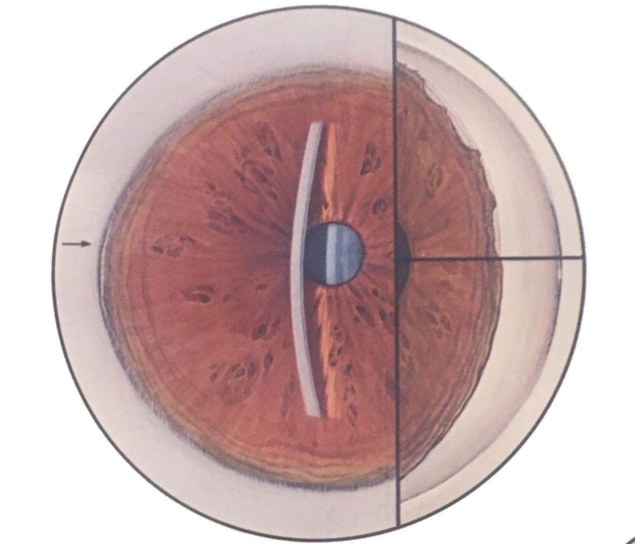 Chronic Angle-Closure Glaucoma - Mr Eyes